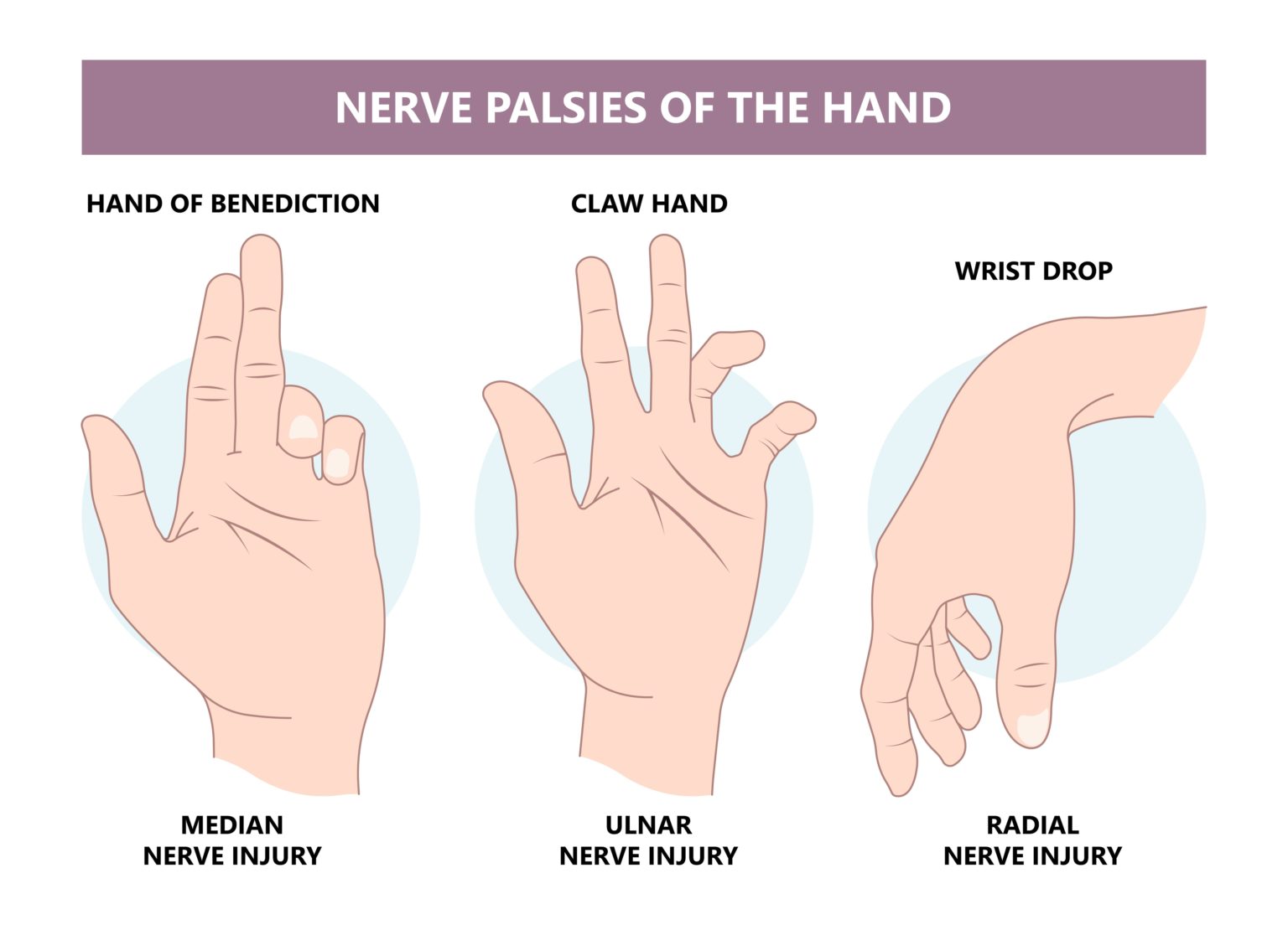 8 Thoracic Outlet Syndrome Exercises for Pain Relief in 2025